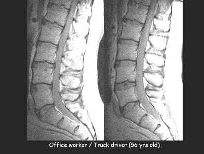 Back Pain May Be Genetic - Study | Science 2.0